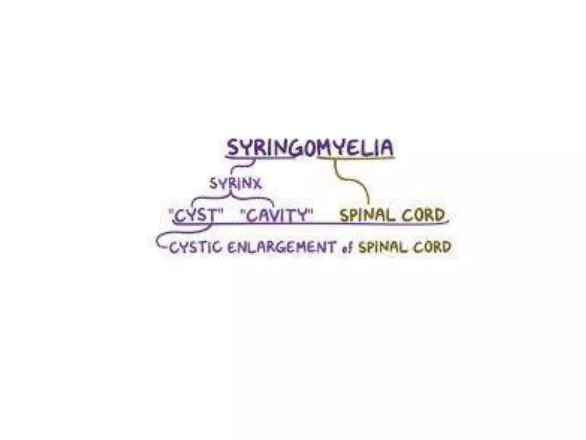 Syringomyelia | PPT