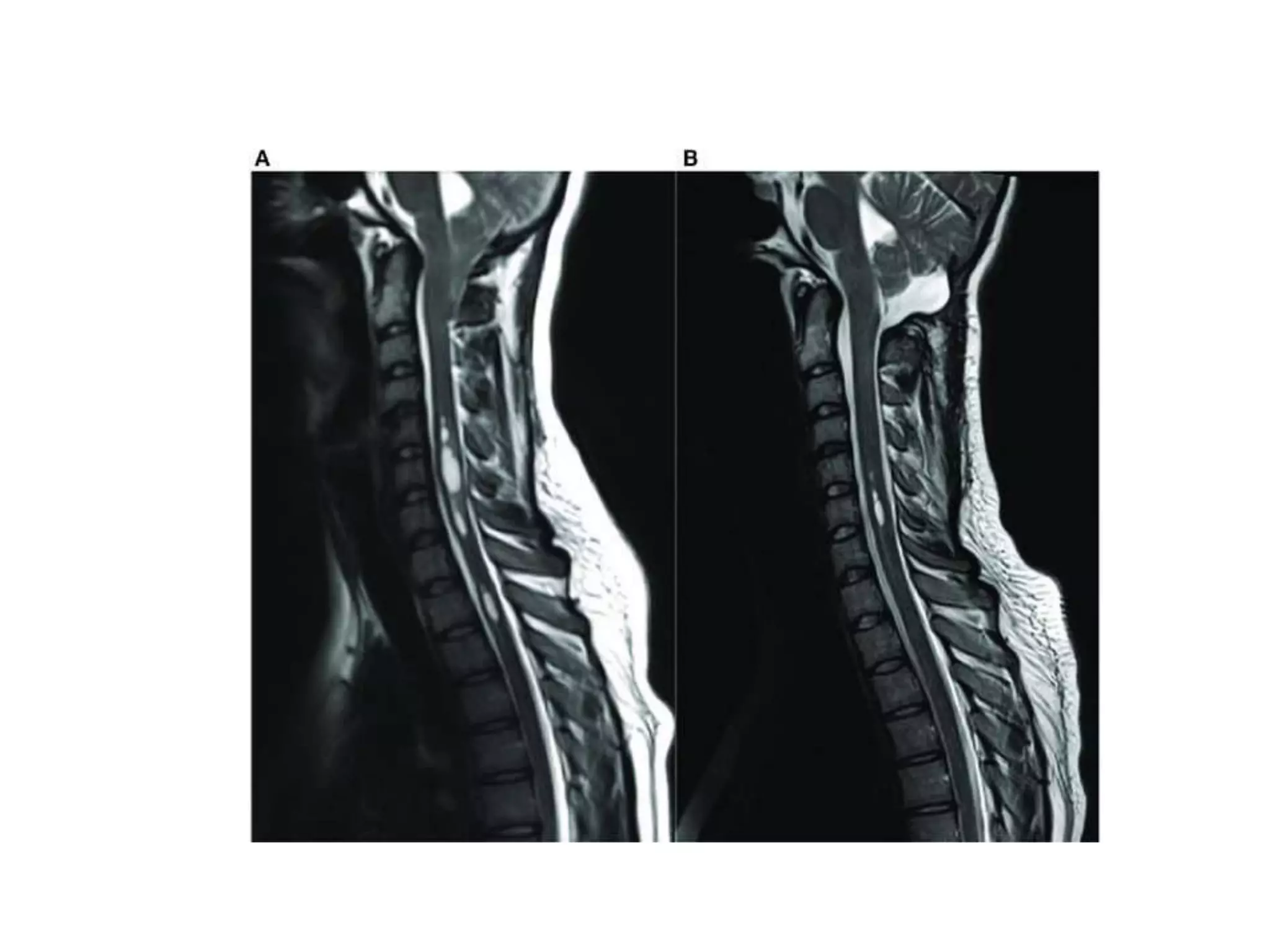 Syringomyelia | PPT