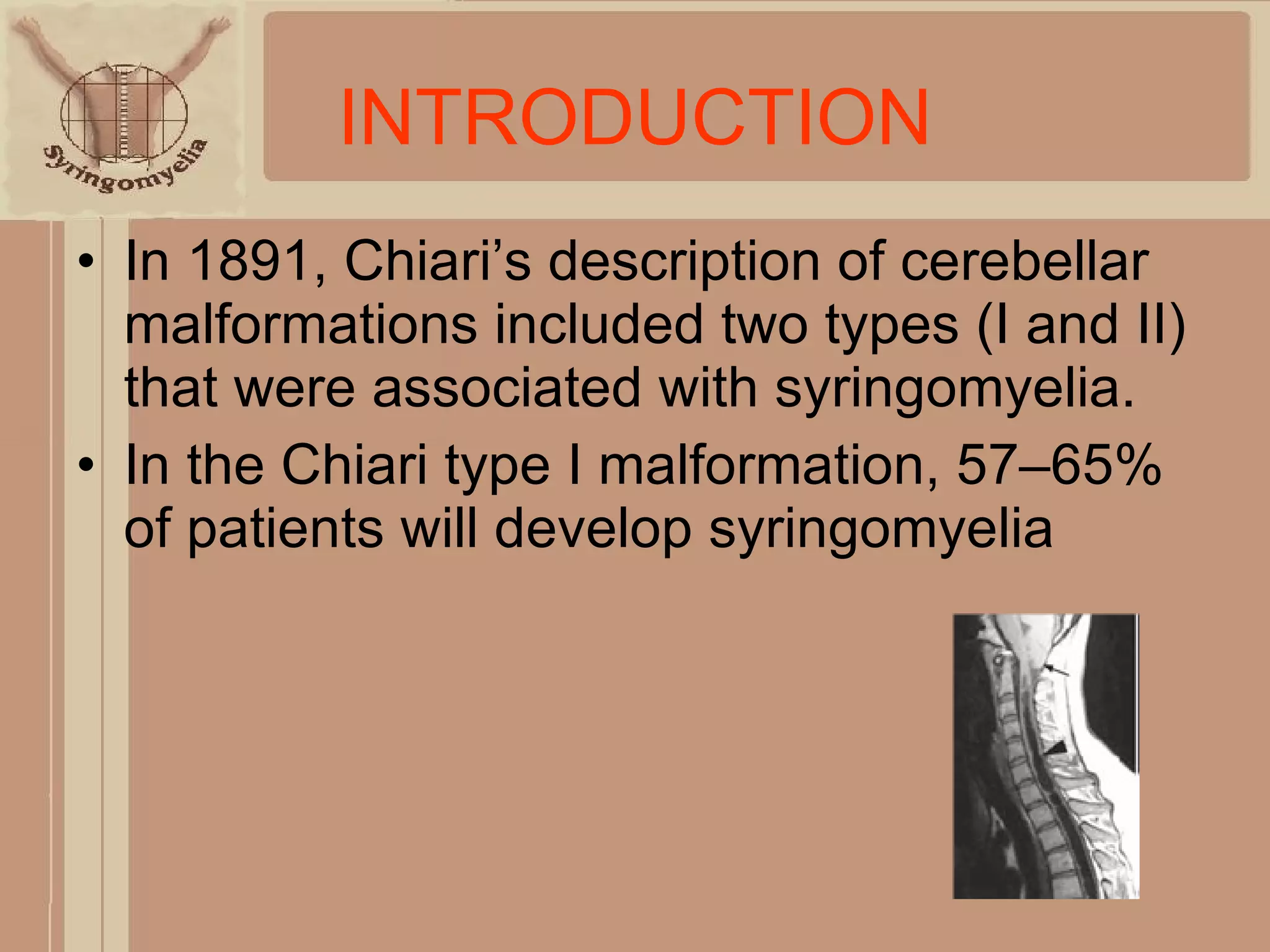 Syringomyelia | PPT