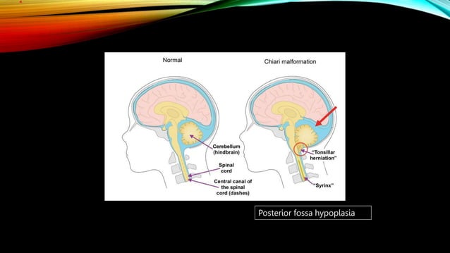 Syringomylia Physiotherapy Percpective.pptx