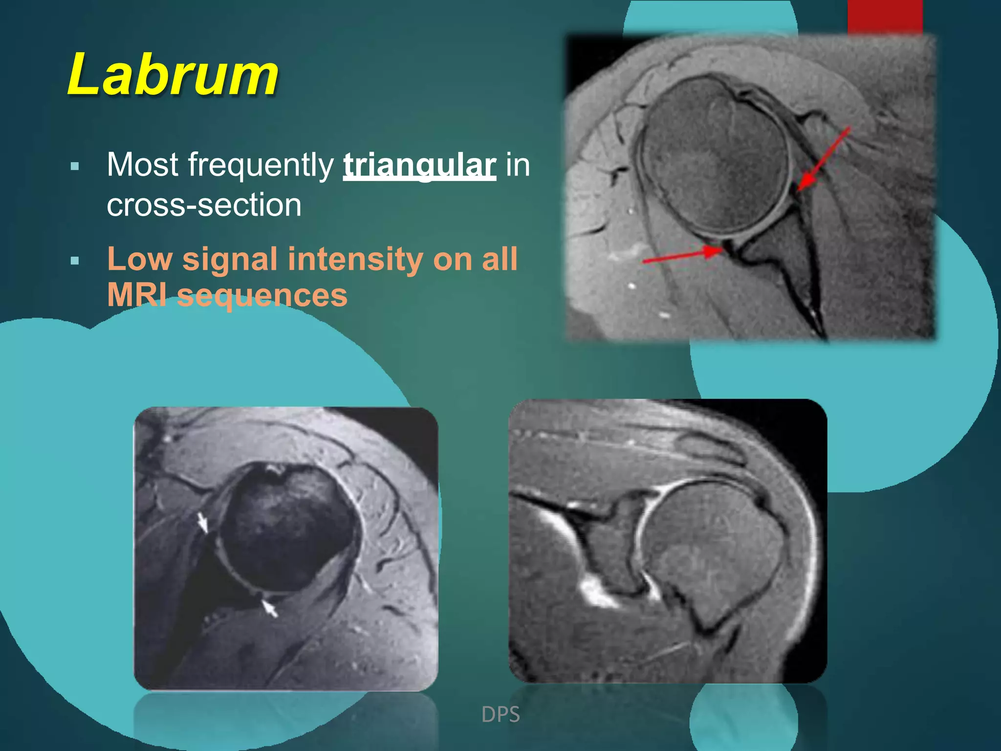 Systematic interpretation of shoulder MRI: DR. D. P. SWAMI | PPTX