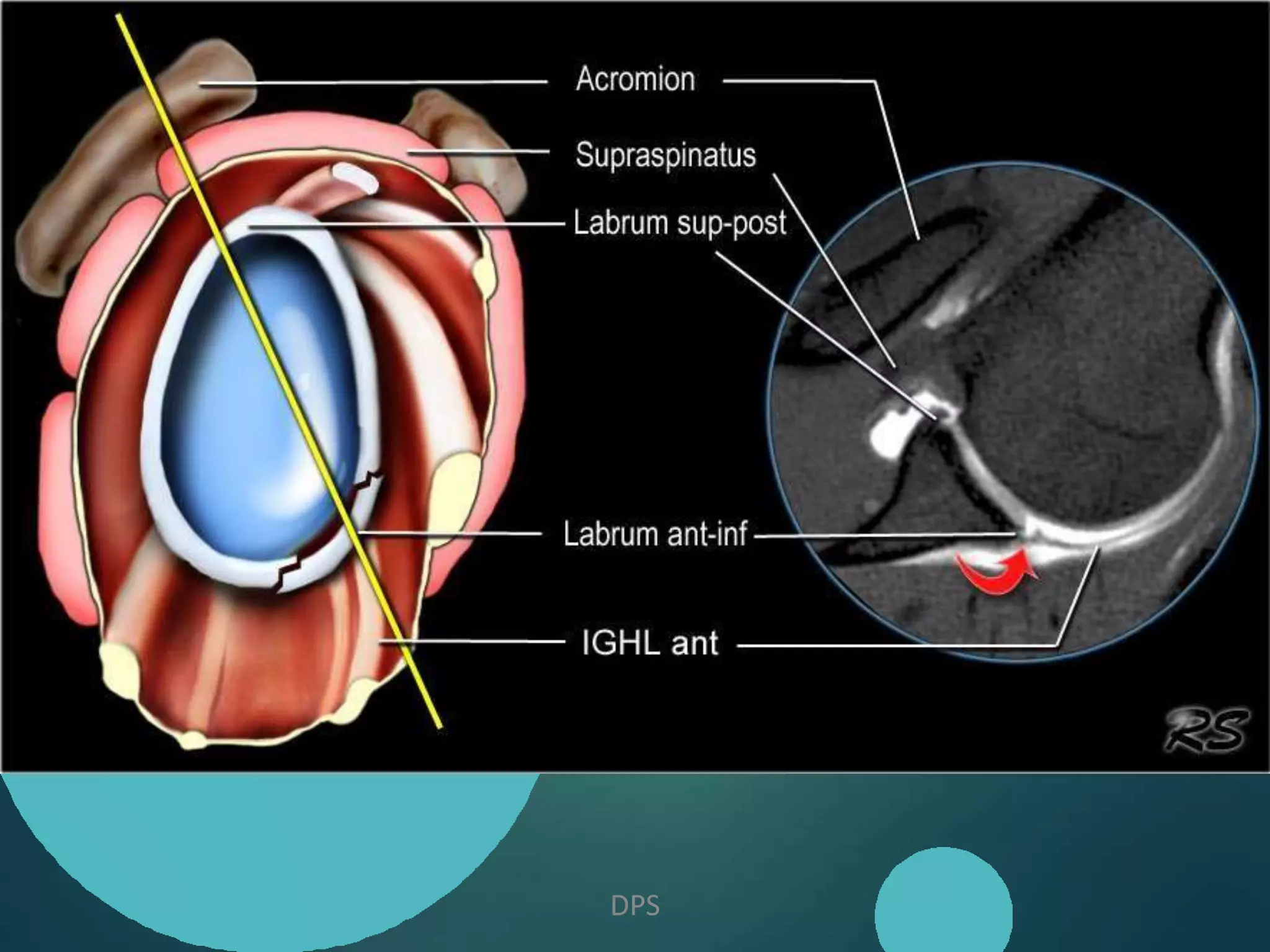 Systematic interpretation of shoulder MRI: DR. D. P. SWAMI | PPTX