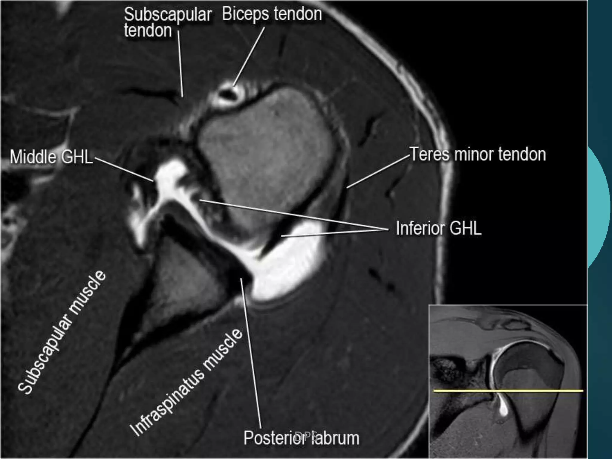 Systematic interpretation of shoulder MRI: DR. D. P. SWAMI | PPTX