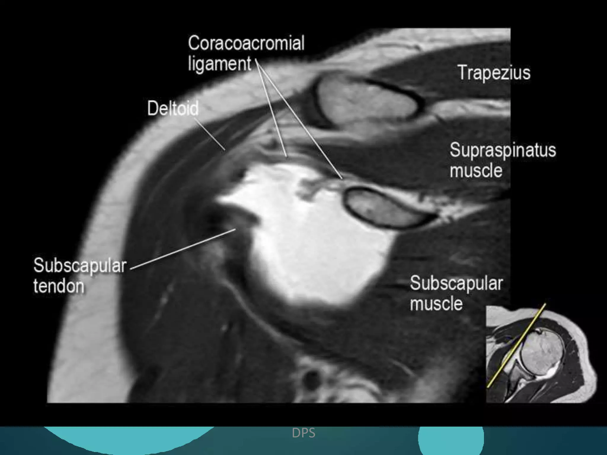 Systematic interpretation of shoulder MRI: DR. D. P. SWAMI | PPTX