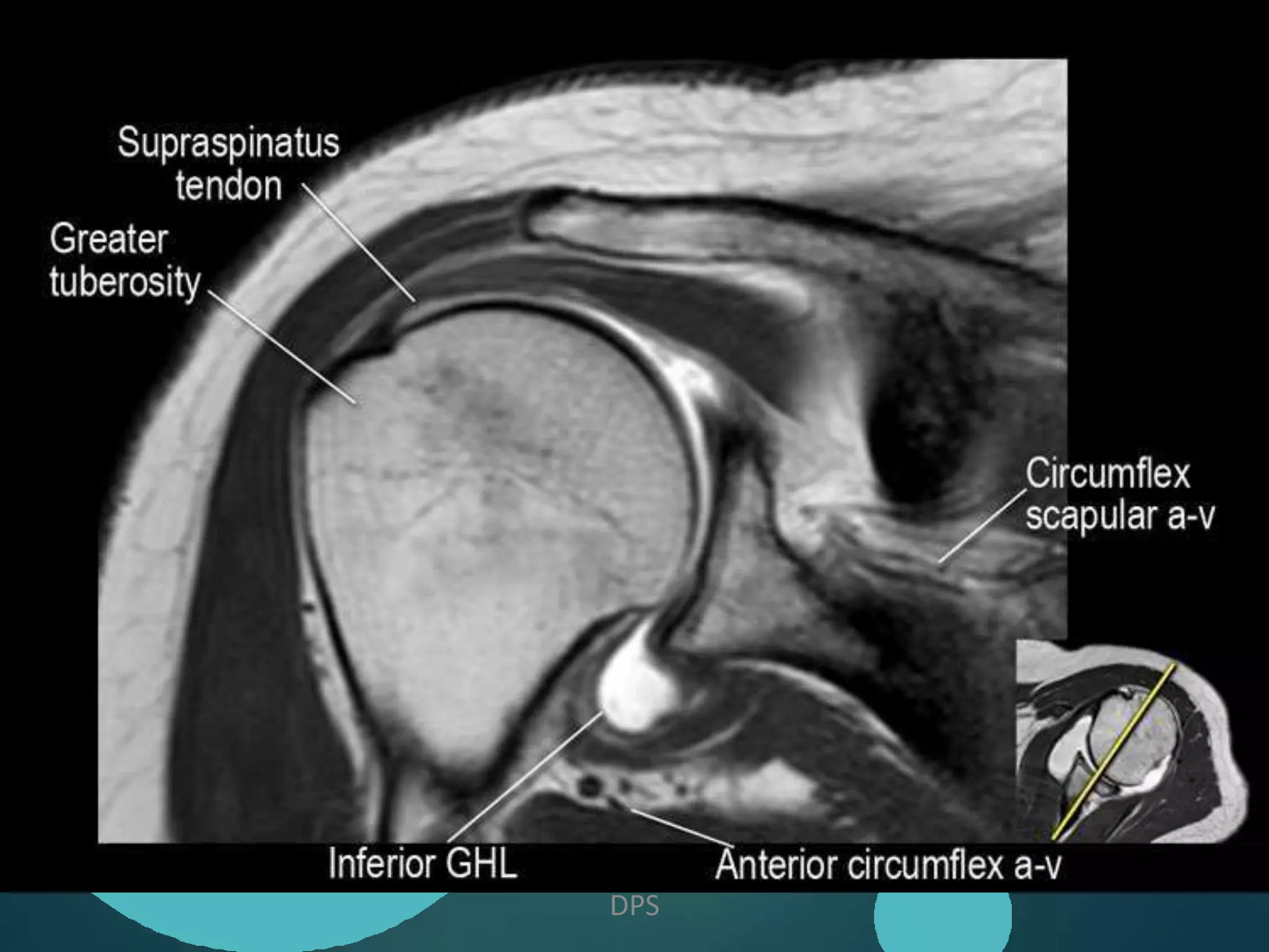 Systematic interpretation of shoulder MRI: DR. D. P. SWAMI | PPTX