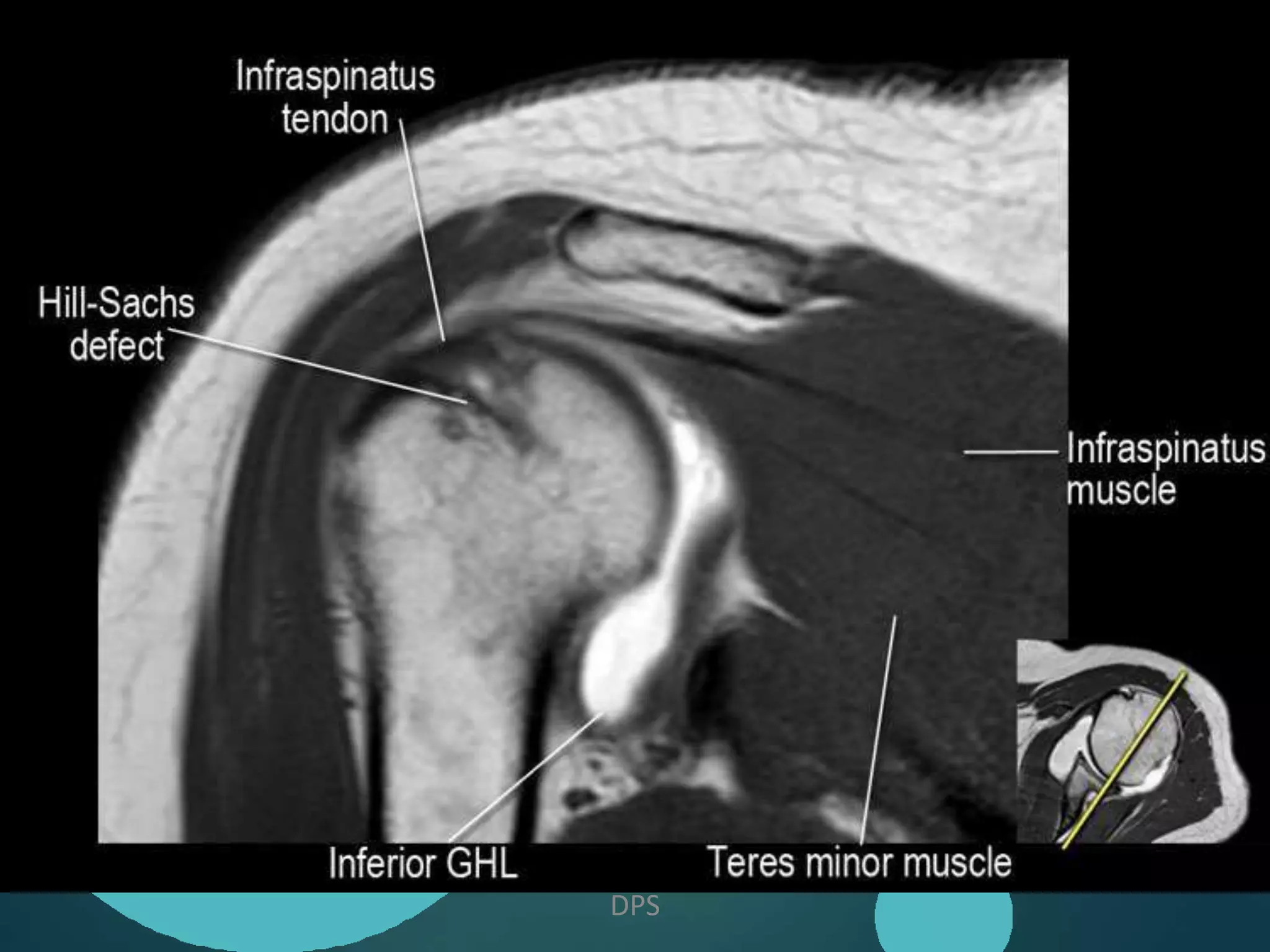 Systematic interpretation of shoulder MRI: DR. D. P. SWAMI | PPTX