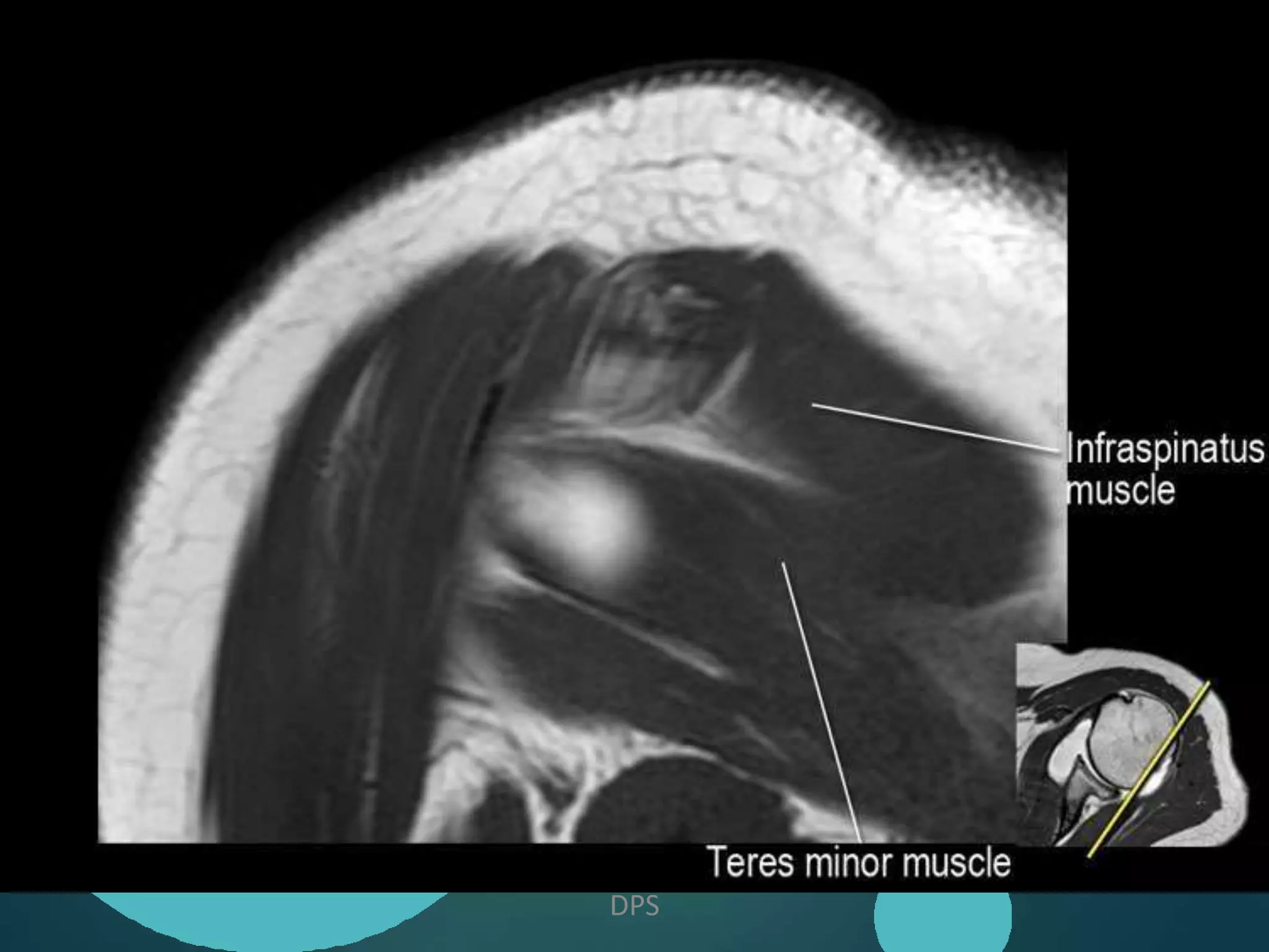 Systematic interpretation of shoulder MRI: DR. D. P. SWAMI | PPTX