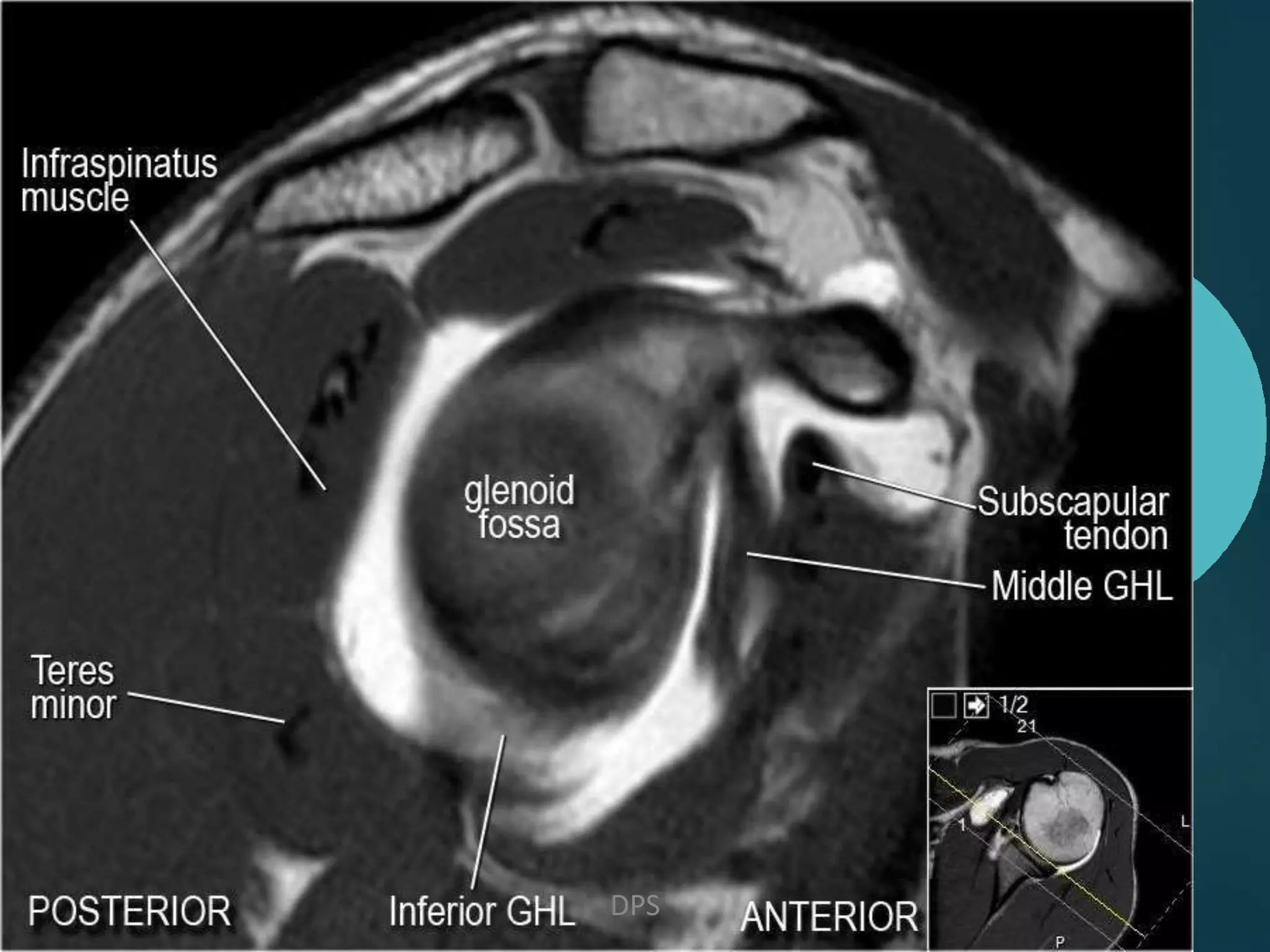 Systematic interpretation of shoulder MRI: DR. D. P. SWAMI | PPTX