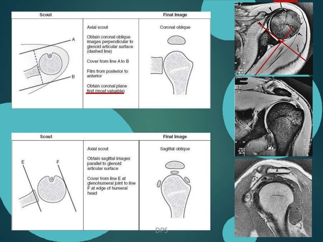 Systematic interpretation of shoulder MRI: DR. D. P. SWAMI | PPTX