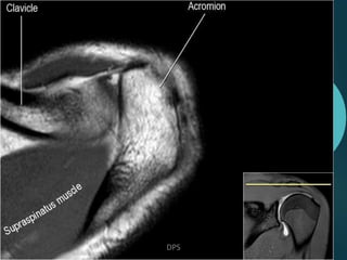 Systematic interpretation of shoulder MRI: DR. D. P. SWAMI | PPTX