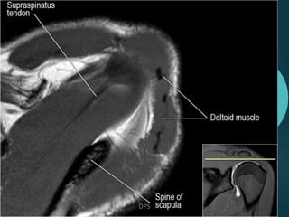 Systematic interpretation of shoulder MRI: DR. D. P. SWAMI | PPTX
