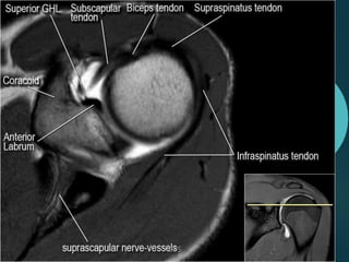 Systematic interpretation of shoulder MRI: DR. D. P. SWAMI | PPTX