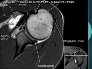 Systematic interpretation of shoulder MRI: DR. D. P. SWAMI | PPTX