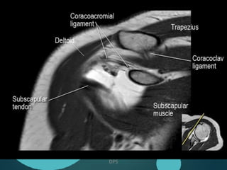 Systematic interpretation of shoulder MRI: DR. D. P. SWAMI | PPTX