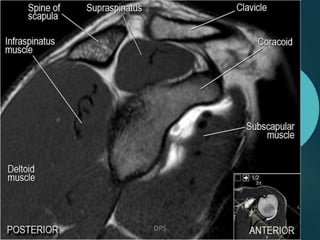 Systematic interpretation of shoulder MRI: DR. D. P. SWAMI | PPTX