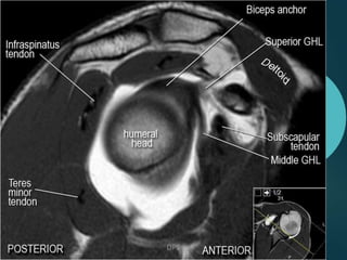 Systematic interpretation of shoulder MRI: DR. D. P. SWAMI | PPTX