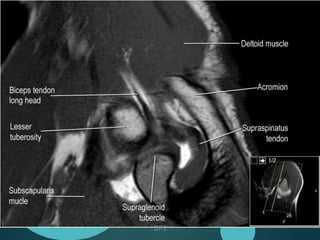 Systematic interpretation of shoulder MRI: DR. D. P. SWAMI | PPTX