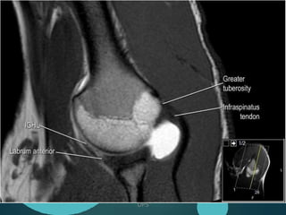 Systematic interpretation of shoulder MRI: DR. D. P. SWAMI | PPTX