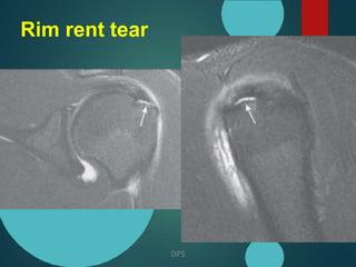 Systematic interpretation of shoulder MRI: DR. D. P. SWAMI | PPTX