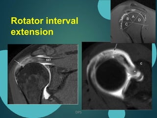 Systematic interpretation of shoulder MRI: DR. D. P. SWAMI | PPTX