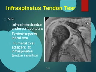 Systematic interpretation of shoulder MRI: DR. D. P. SWAMI | PPTX