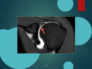 Systematic interpretation of shoulder MRI: DR. D. P. SWAMI | PPTX