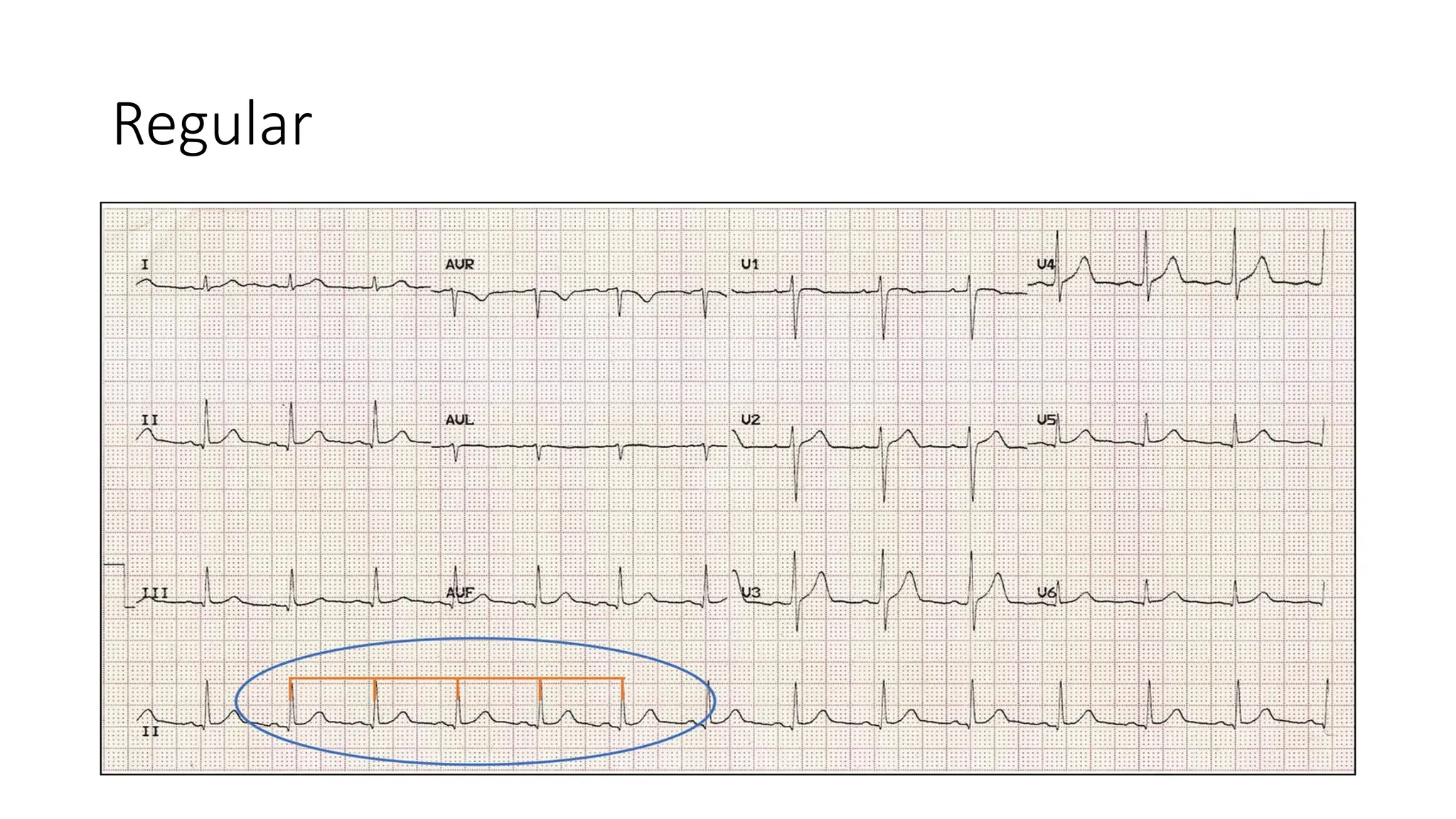 Systematic Approach in Interpretation of Normal ECG.pptx