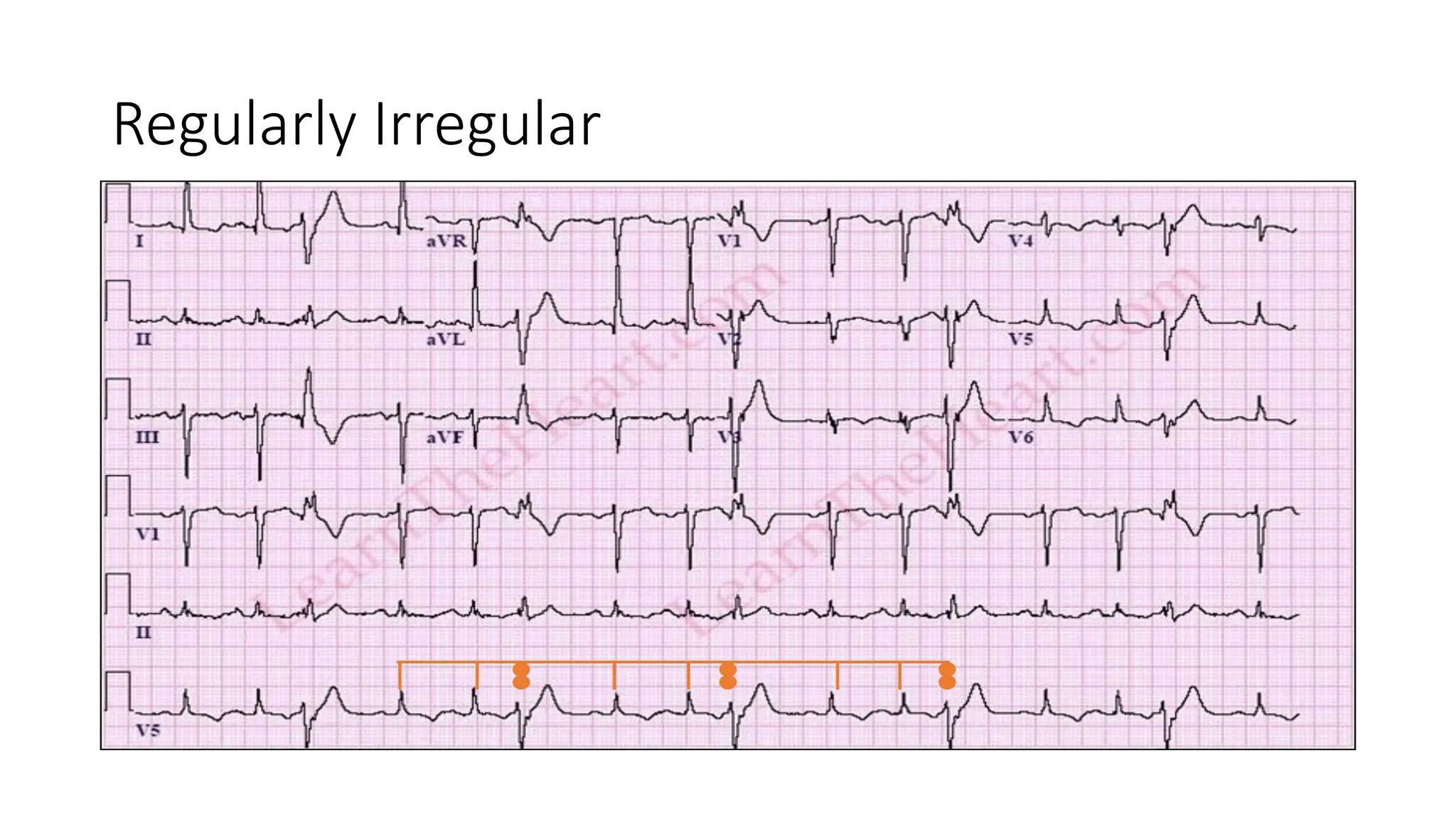 Systematic Approach in Interpretation of Normal ECG.pptx
