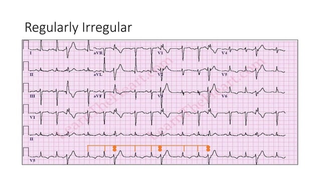 Systematic Approach in Interpretation of Normal ECG.pptx