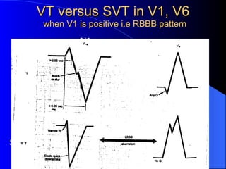 Systematic approach to wide qrs tachycardia | PPT