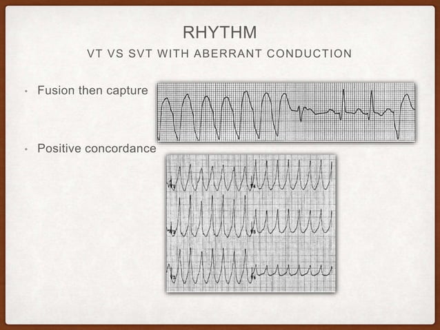 Systematic ECG analysis | PPTX