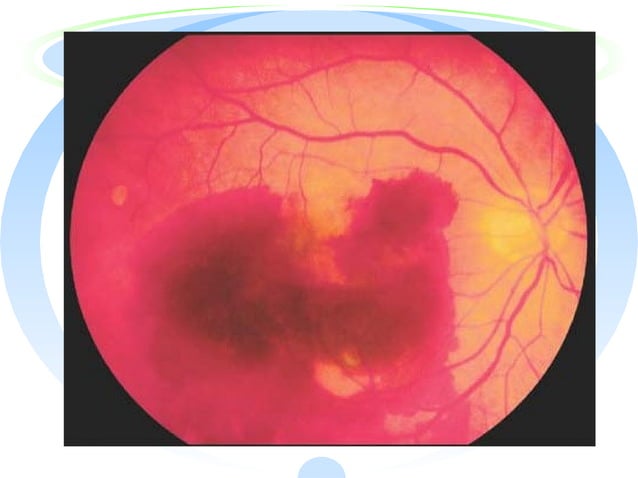 Systematic fundus examination | PPT