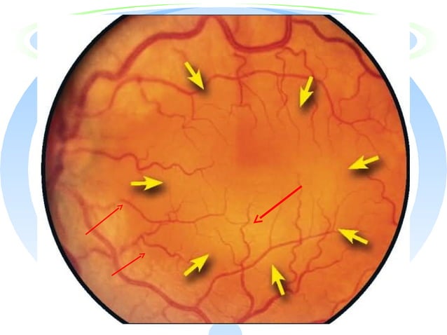 Systematic fundus examination | PPT