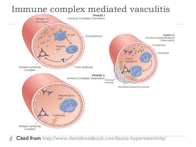 Systematization and diagnosis of vasculitides. Mikhail Valivach