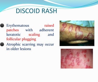 systemic-lupus-erythematosus pahrmacaotherapeutics.pdf