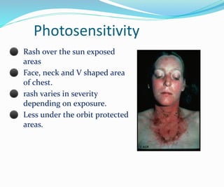 systemic-lupus-erythematosus pahrmacaotherapeutics.pdf