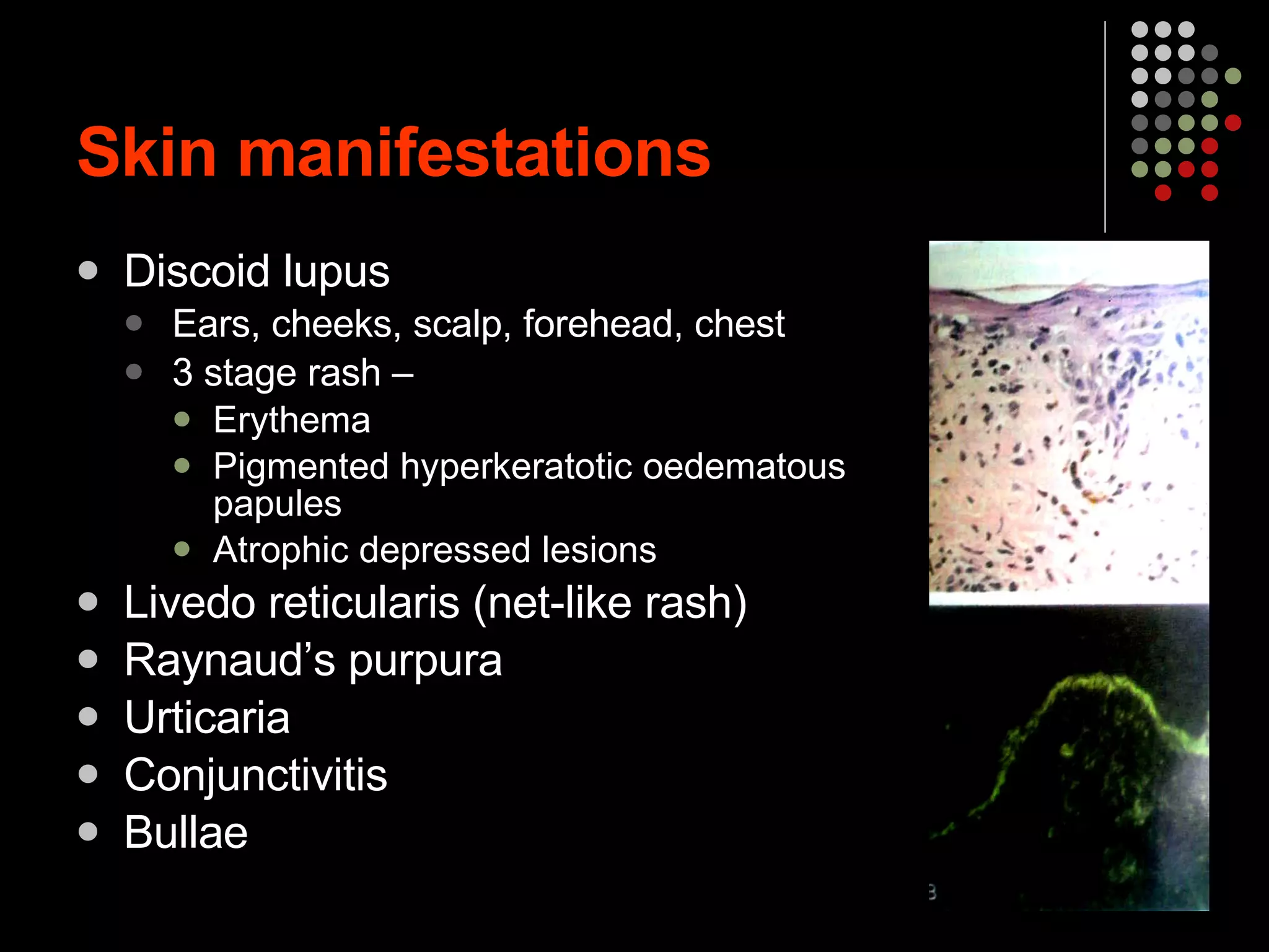 Systemic Lupus Erythematosus | POT