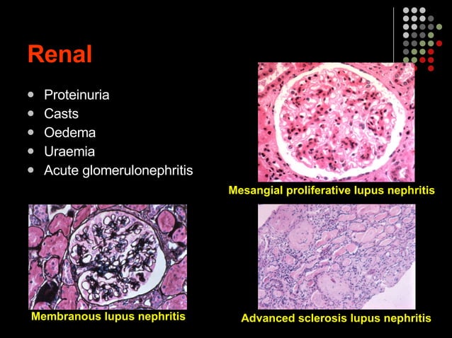 Systemic Lupus Erythematosus | POT