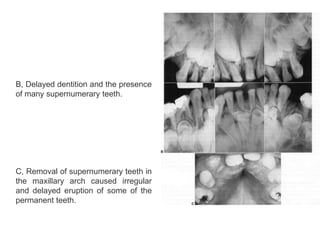 Systemic and congenital factors that influence the process of eruption ...