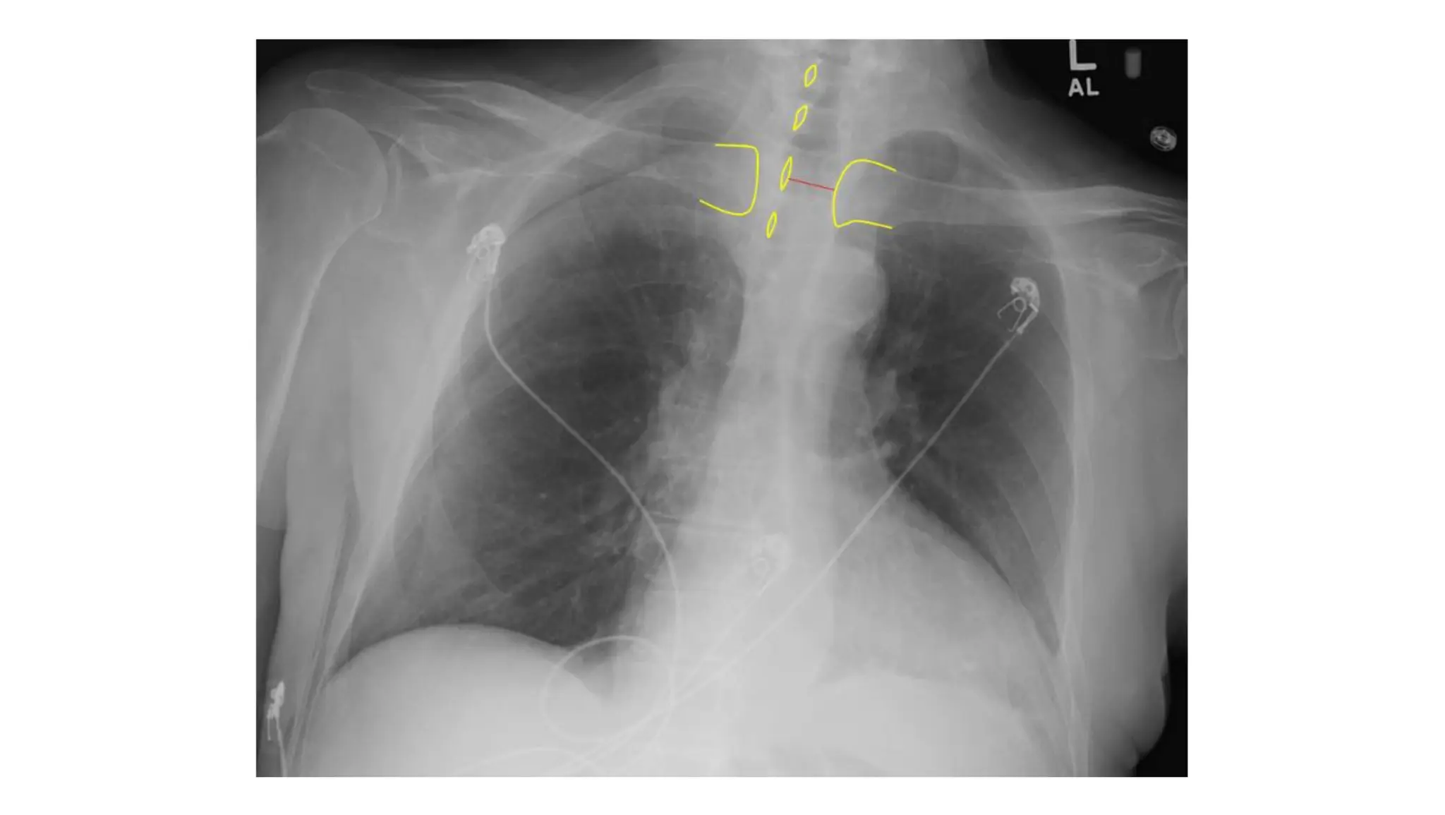 Systemic approach for reading Chest X-rays.pdf
