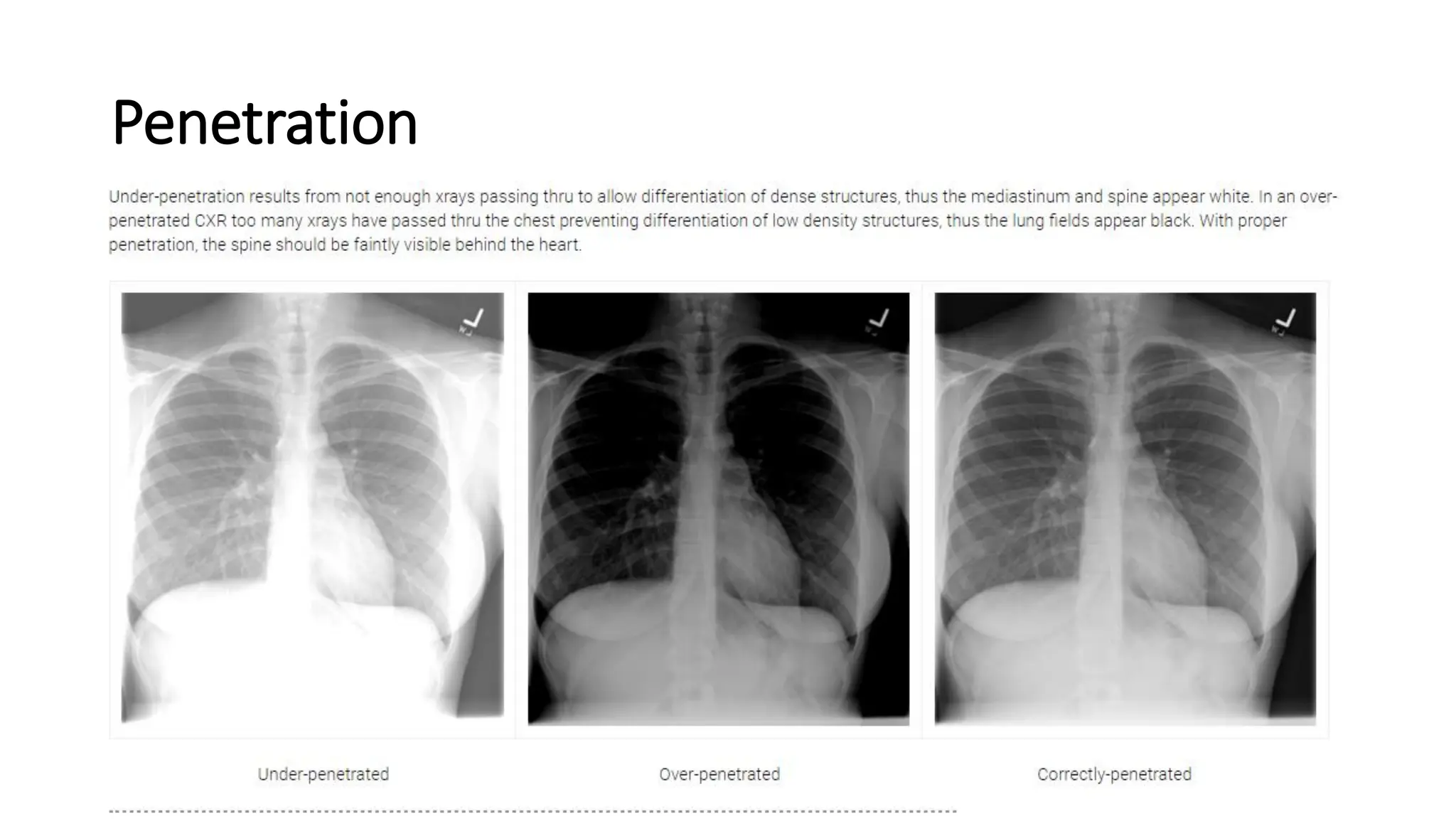 Systemic approach for reading Chest X-rays.pdf | Lung and Respiratory ...