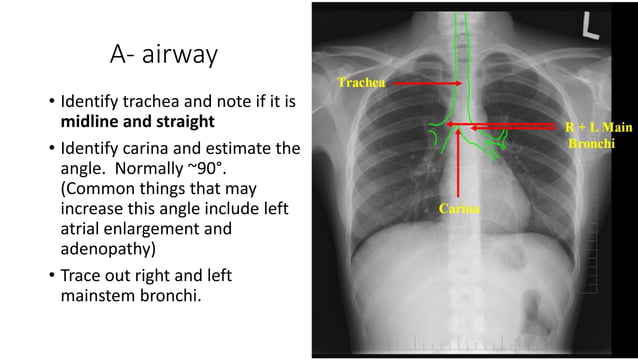 Systemic approach for reading Chest X-rays.pdf | Lung and Respiratory ...