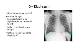 Systemic approach for reading Chest X-rays.pdf