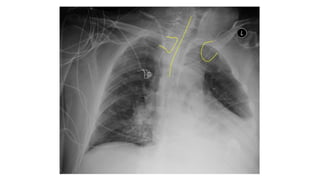 Systemic approach for reading Chest X-rays.pdf | Lung and Respiratory ...