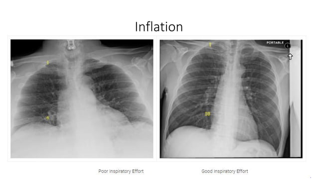 Systemic approach for reading Chest X-rays.pdf | Lung and Respiratory ...