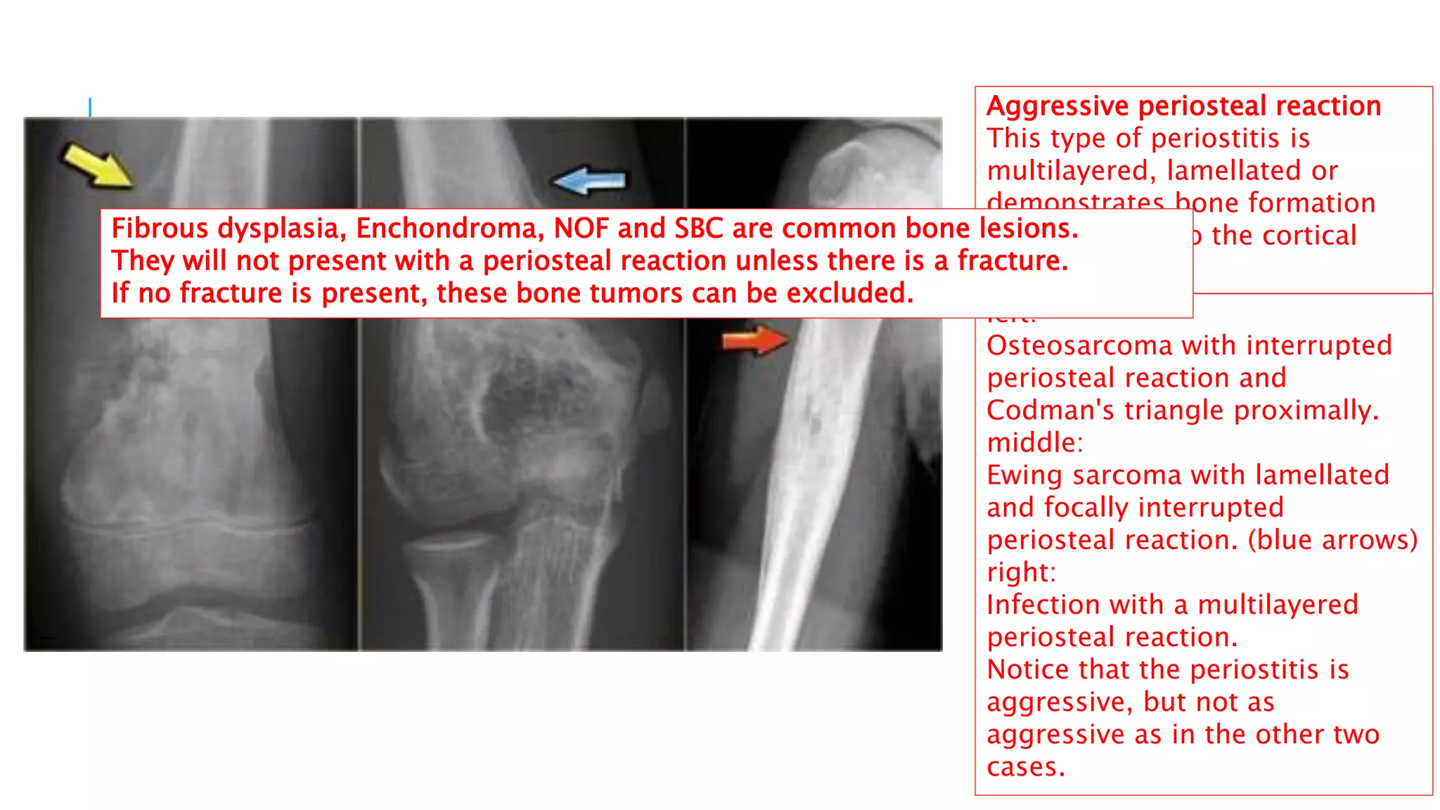 Systemic approach to bone tumor radiology | PPTX