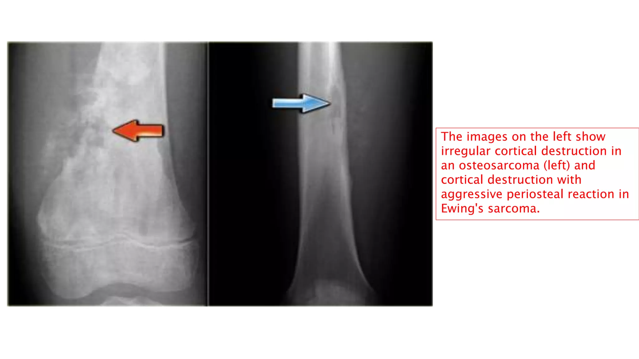 Systemic approach to bone tumor radiology | PPTX