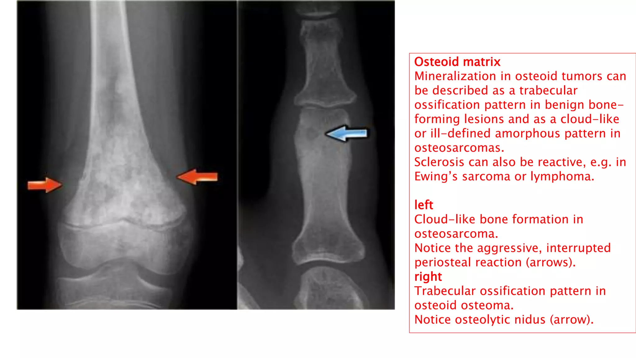 Systemic approach to bone tumor radiology | PPTX