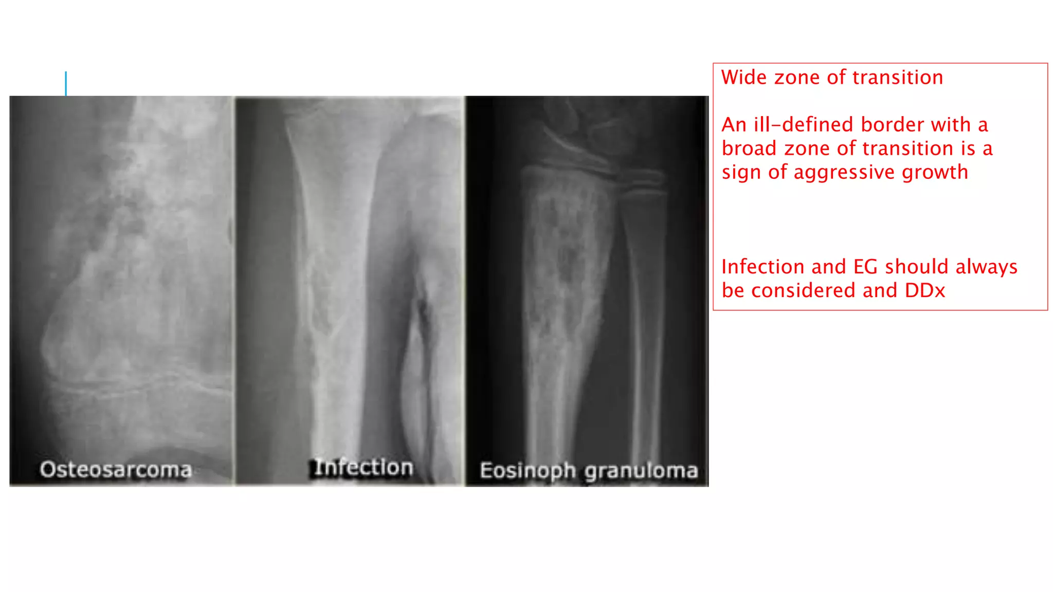 Systemic approach to bone tumor radiology | PPTX