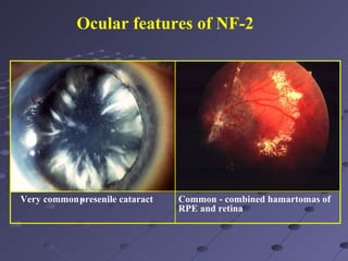 Systemic Diseases and the Eye | PPT